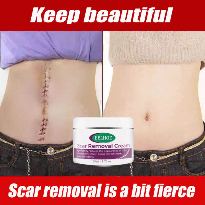 scar remover scar remover for old scar on legs scar remover for old ...