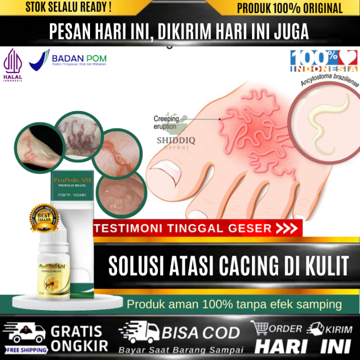 Obat Tetes Cacing Di Bawah Kulit Anak, Penghilang Cutaneous Larva ...