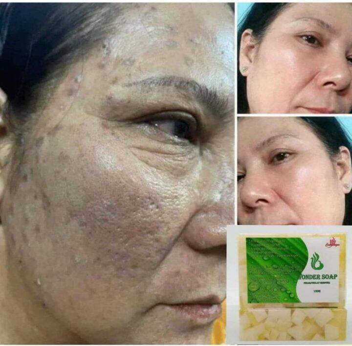 Wonder Soap for Pekas and Peklat Whitening Soap Effective Glutathione ...