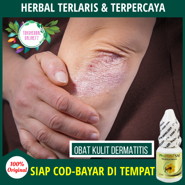 Obat Dermatitis, Obat Gatal Penyakit Dermatitis, Obat Kulit Dermatitis ...