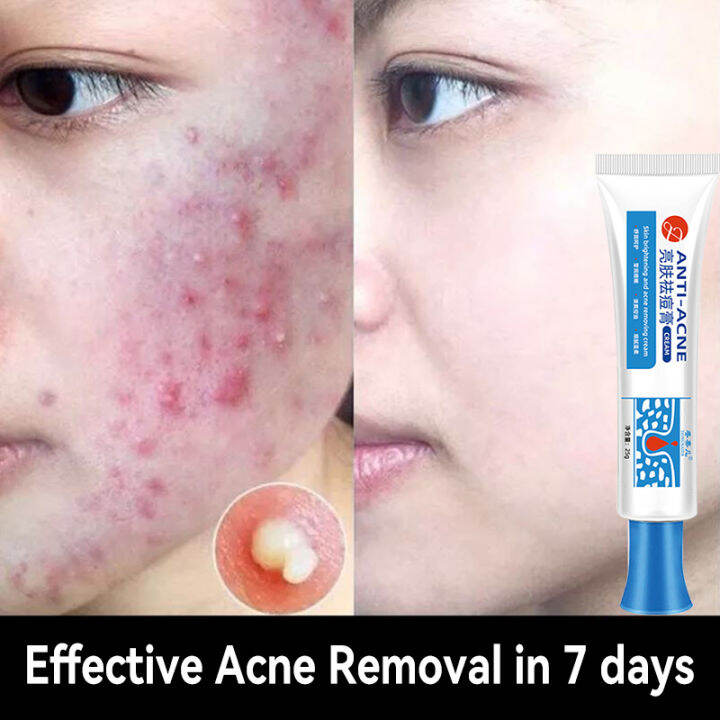 【COD】🎀🎀100% Effective Anti Acne and Pimples Cream Quickly Pimples Remover Effective Acne ...