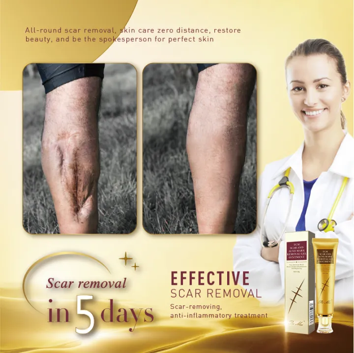 stretch mark remover Scar Remover stretch mark remover Acne/Burn/Spots ...