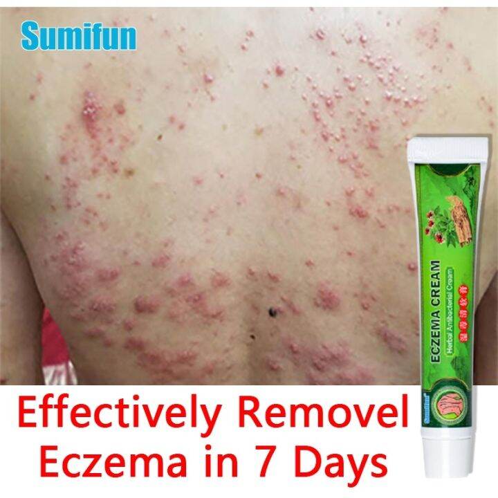 Sumifun Eczema Cream Gamot Sa Kati Kati Sa Balat Ointment for Itchy ... Sumifun Eczema Cream Gamot Sa Kati Kati Sa Balat Ointment for Itchy ...