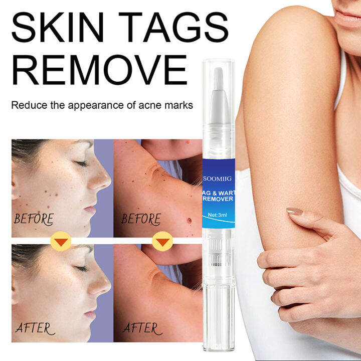 【Hot Sale】 Mole removal pen, Portable mole removing pen，Mole removal ...