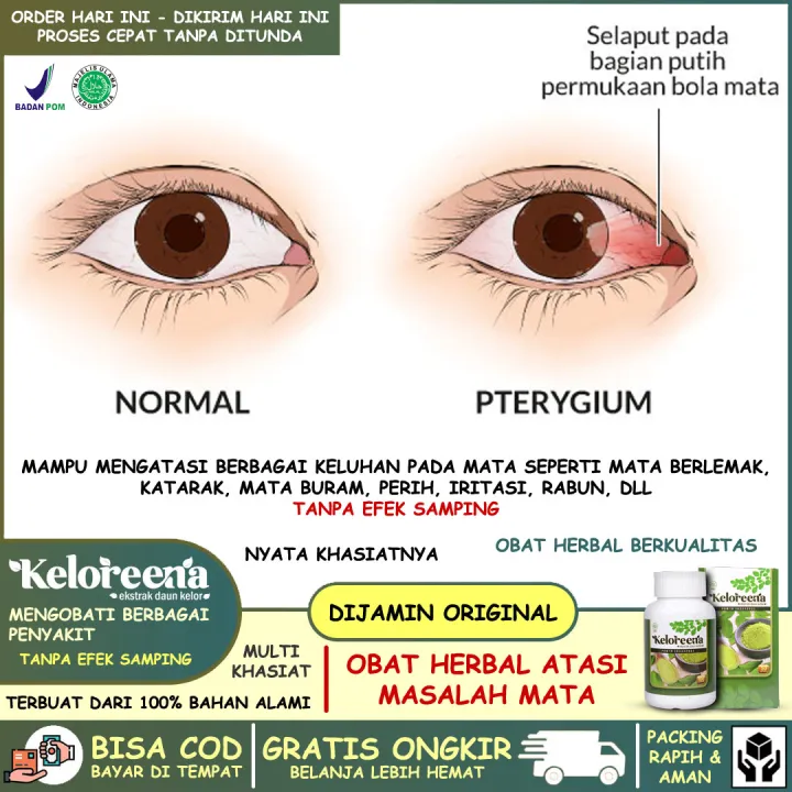 Obat Penghilang Lemak Di Mata Berlemak Pterygium Penglihatan Terhalang ...
