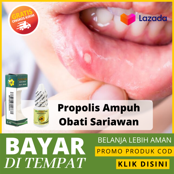 Obat Sariawan - Obas Alami Sariawan - Obat Sariawan Di Mulut - Obat ...