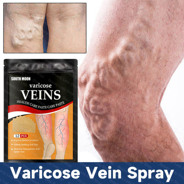 Varicouse Varicose Vein Patch Plaster 12pcs Varicose Veins Patch ...