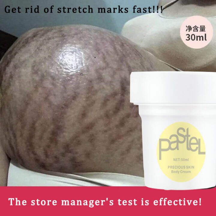 Stretch Mark Removal Cream Stretch Mark Reduction Scar Removal Cream ...