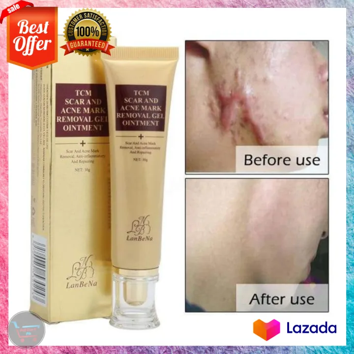 LANBENA Original TCM Acne Scar Removal Cream Pimple Stretch Marks ...
