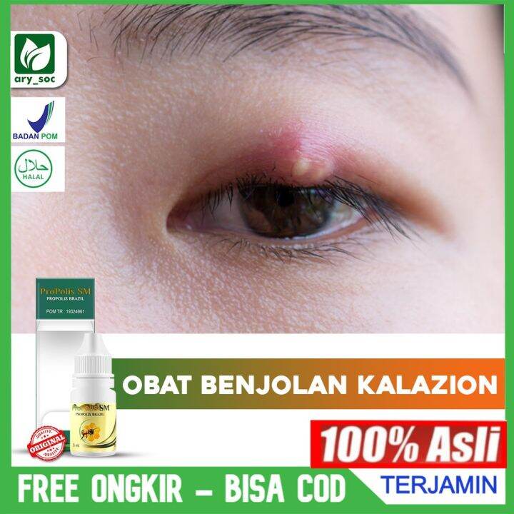 Obat Kalazion - Sakit Mata Bintitan Menahun - Benjolan Kelopak Mata ...