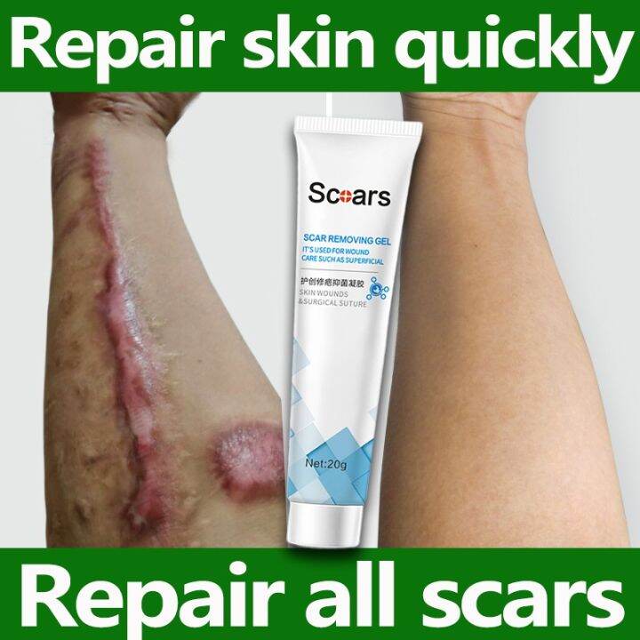Scar Remover Cream Scar Repair Gel Pregnancy Surgery Burn Scars Stretch ...
