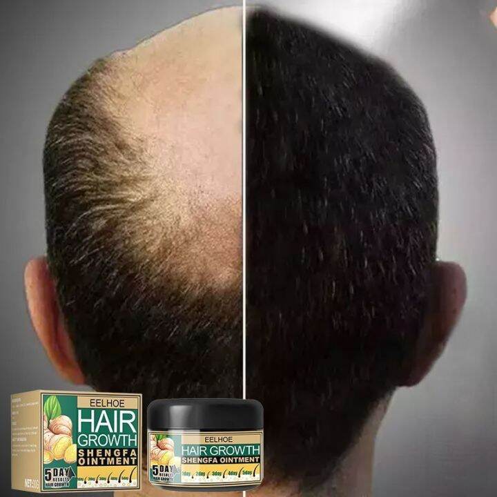 hair grower for men original hair treatment hair grower hair loss ...