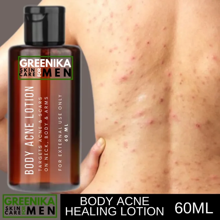 [ Anti Acne Lotion For Men ] Greenika For Men Body Acne Healing Lotion