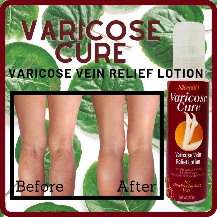 Varicose Vein Cure Relief Ointment Boy Lotion treatment for spider legs ...