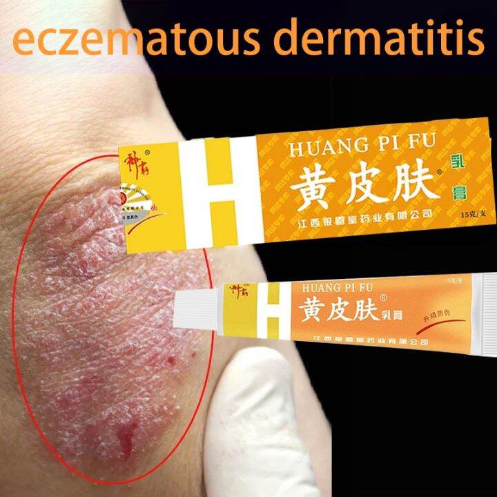 Psoriasis Eczema Cream Antifungal Antibacterial Itchy Cream Itchy