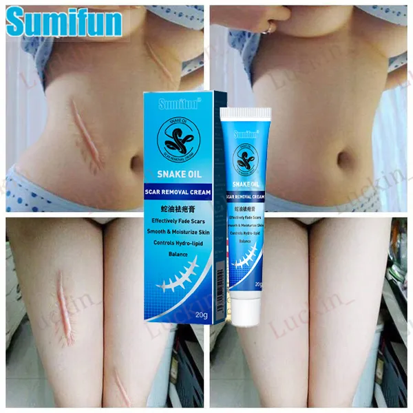 【sumifun】scar Removal Cream Acne Treatment Stretch Marks Removal