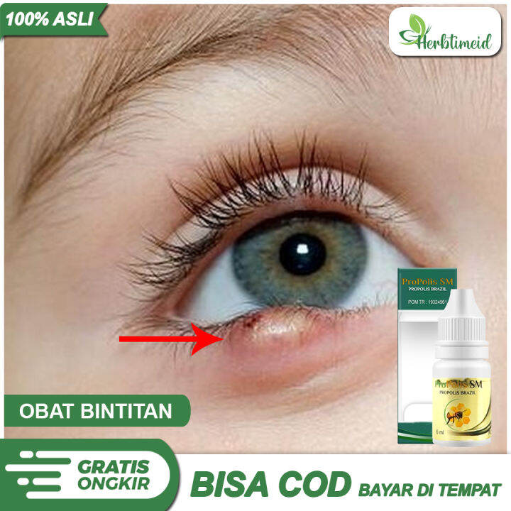 Obat Mata Cindil Bintitan - Benjolan Mata Kalazion - Kelopak Mata ...