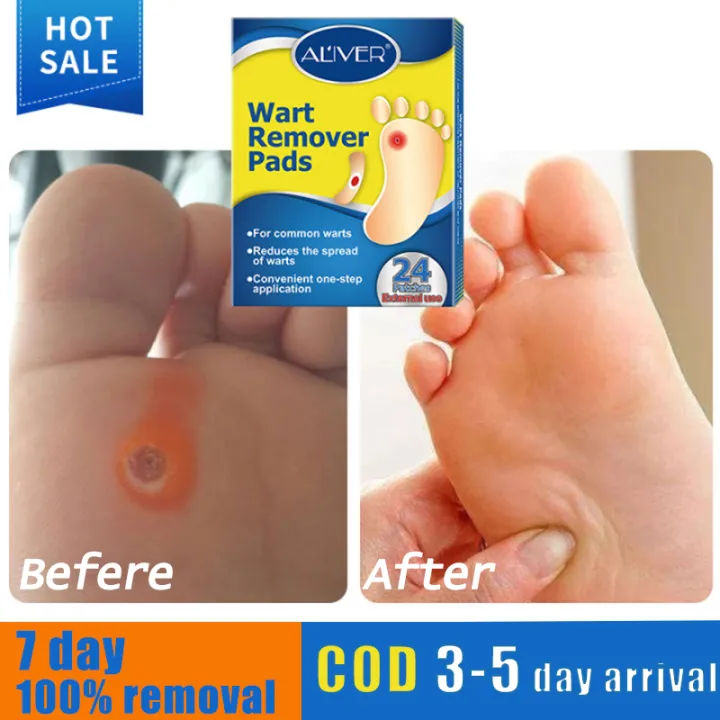 Aliver 24Pcs Feet Corns/ Warts Removal Patch Pain Relief Remover Feet ...