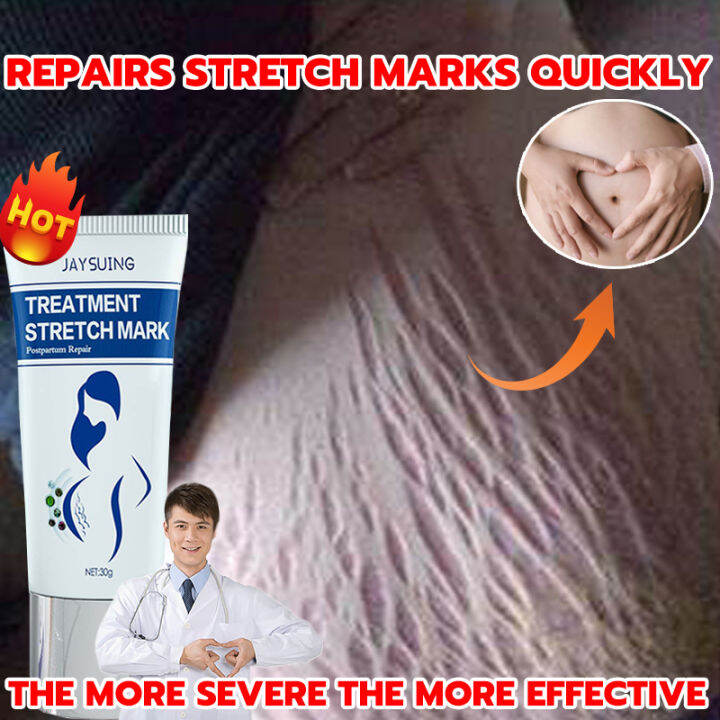 Strechmark Removal Effective Obesity Lines Remover Strech Mark Remove