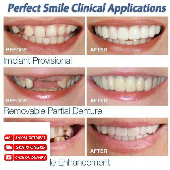 PAKETAN SEPASANG atas bawah SnapOn Smile Authentic Gigi Palsu Snap on ...