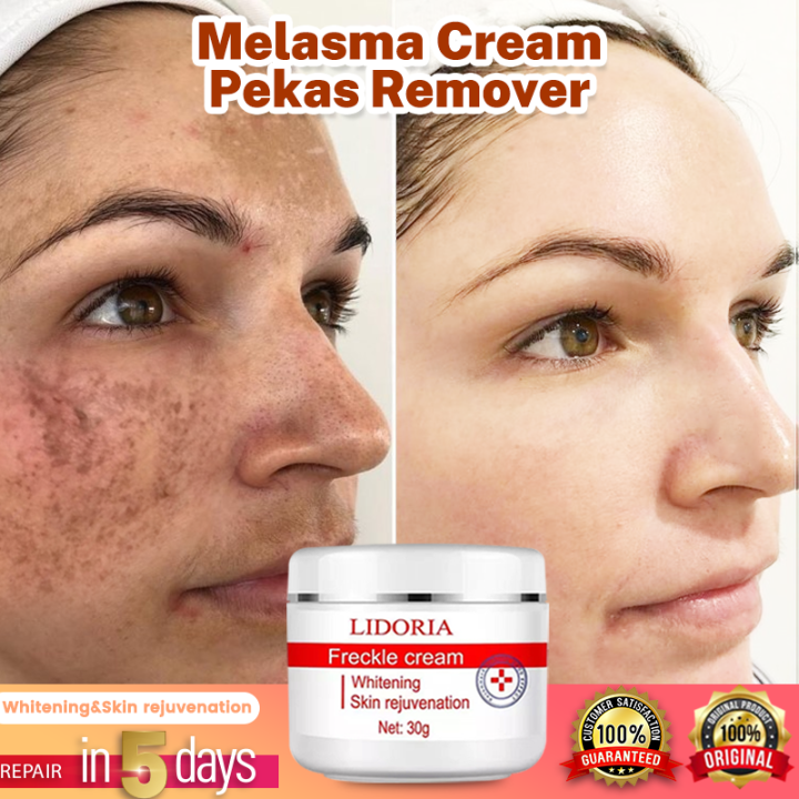 pekas remover cream original melasma and pekas remover melasma remover ...