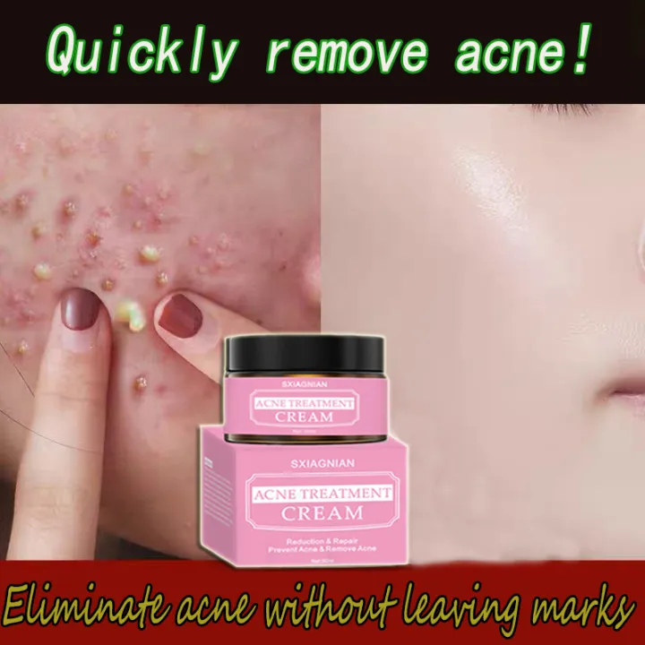 pimple marks remover Pimple cream quickly&effectively remove acne fade acne scar ，repair skin ...