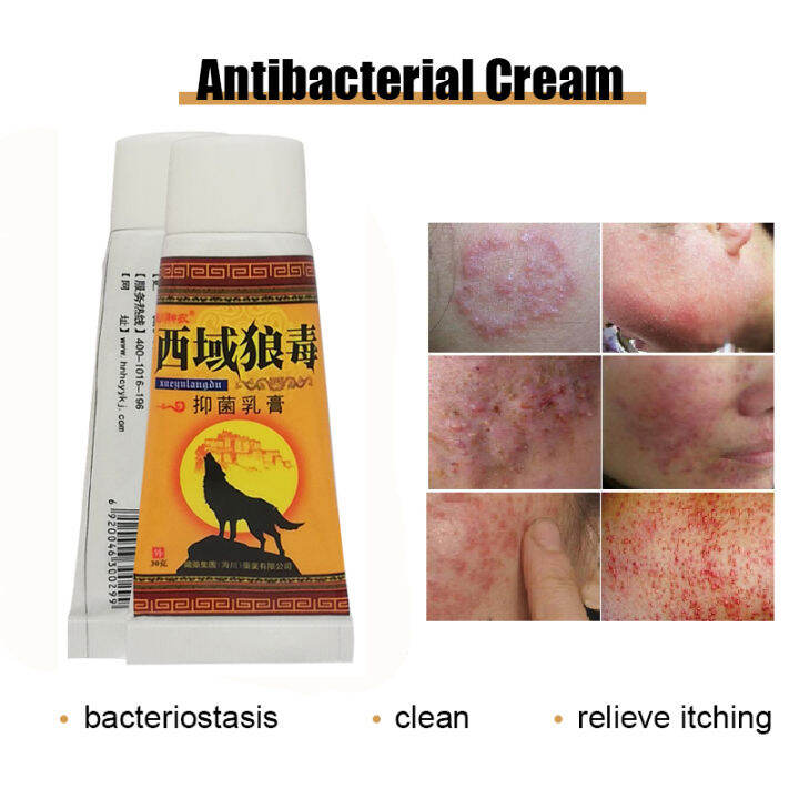 Fungal Infection Eczema Treatment at Sherlyn Weyer blog