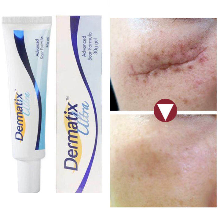 Dermatix Scar Removal Cream Scar Gel Old Scars Acne Remover Skin Repair ...