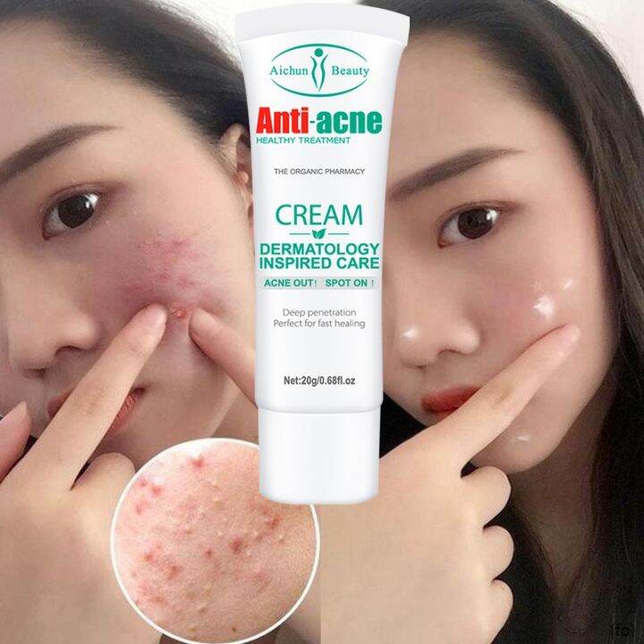 Acne remover cream Pimple eraser Pimple marks remover Pore minimizer ...