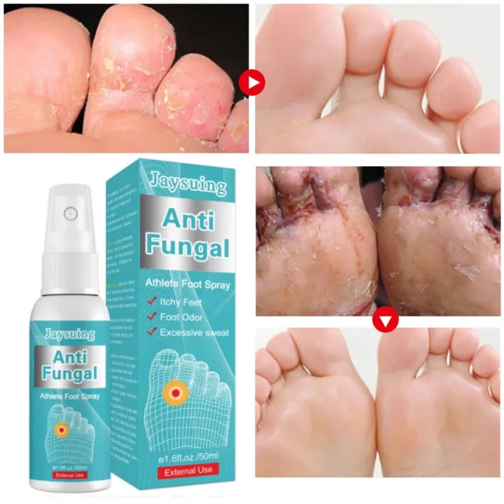 Herbal Antifungal Foot Spray Treatment Athlete 39;s Itching Eczema Anti ...