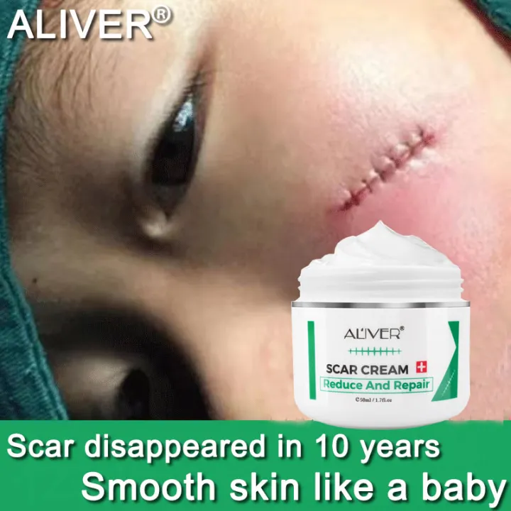 ALIWER 50ml Scar cream scar remover for kids Remove old and new scars ...