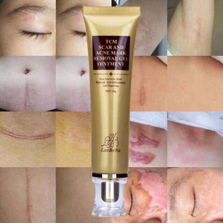MZ wise Authentic LANBENA TCM Scar and Acne Mark Removal Gel Ointment 30g | Lazada PH