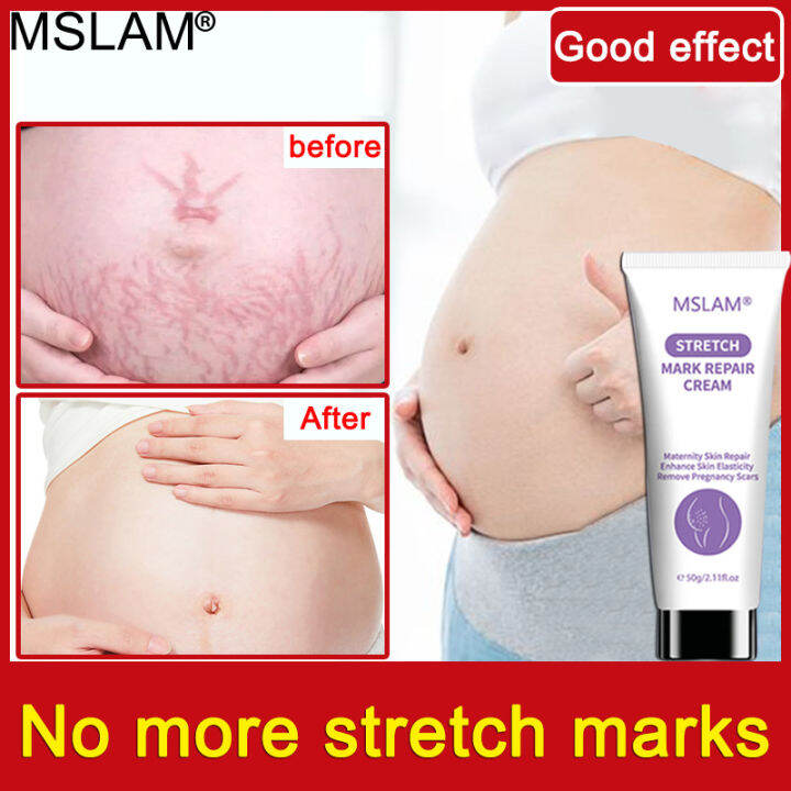 US Best Selling MSLAM Stretch Mark Cream , Whitening and Brightening ...