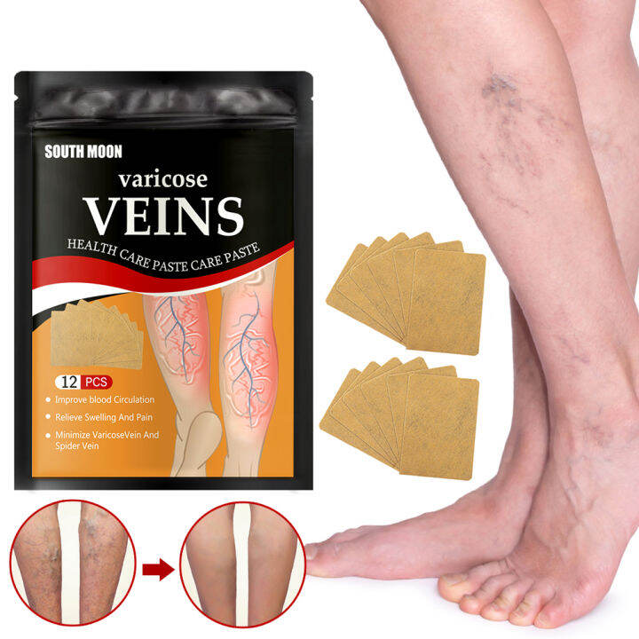 12Pcs Varicose Veins Relief Patch Thigh Leg Pain Removal Phlebitis ...