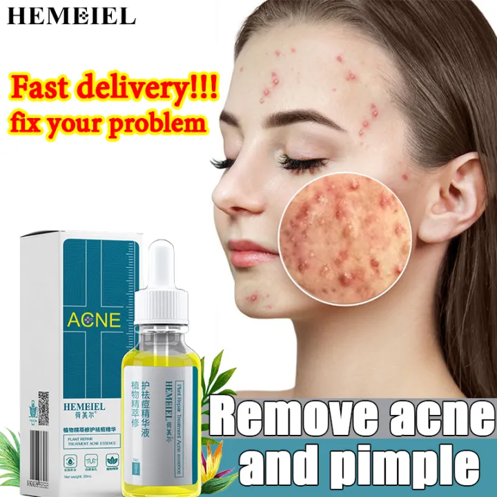 HEMEIEL pimples acne remover best seller acne remover serum pang ... HEMEIEL pimples acne remover best seller acne remover serum pang ...