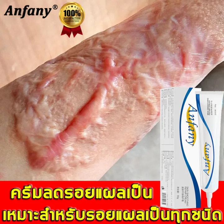 Anfany ครีมทารอยแผลเป็น 30g กำจัดรอยแตกลาย แผลไฟไหม้ น้ำร้อนลวก ซ่อมแซมผิวที่เสียหาย บำรุงผิวให้ ...
