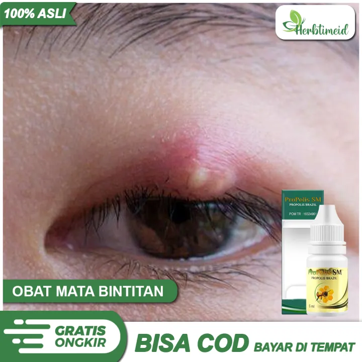 Obat Mata Bintitan - Benjolan di Kelopak Mata Atas - Salep Mata ...
