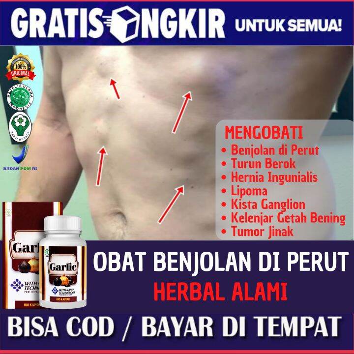 Obat Benjolan di Perut Turun Berok Hernia Ingunialis Lipoma Kista ...