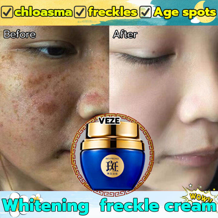 Melasma and pekas remover serum, melasma removal cream original ...
