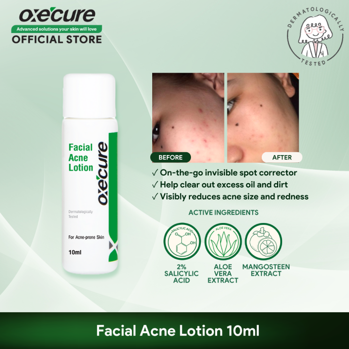 OXECURE 2% Salicylic Acid Facial Acne Lotion 10ml [Pimples, blackheads ...