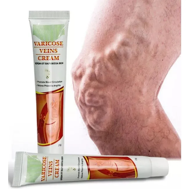 Salep Varises Cream Varicose Veins Obat Varises Varikokel Bengkak ...
