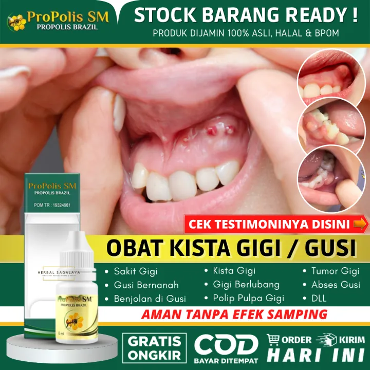 OBAT KISTA GIGI - OBAT BENJOLAN DI GUSI - PENGHILANG BENJOLAN DI GIGI BERLUBANG - TUMOR GIGI ...