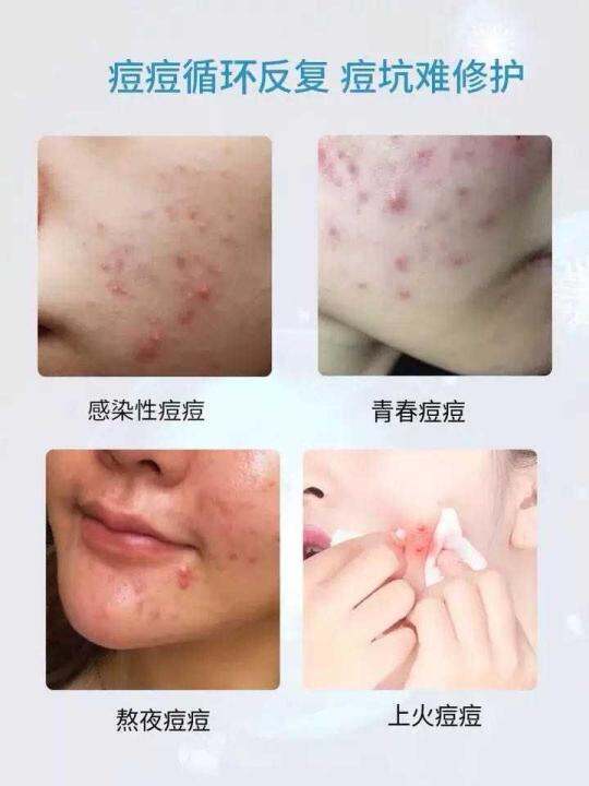 Fading cream for removing acne marks, removing acne pits, scars and ...