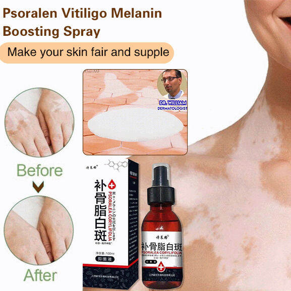 greatfunny Psoralen Vitiligo Melanin Boosting Spray | Lazada PH