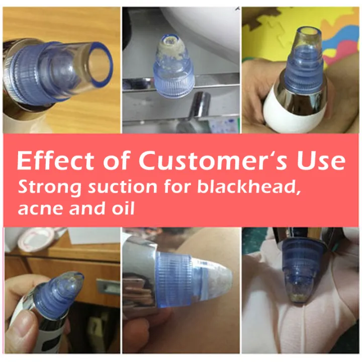BIOSKIN Blackhead Sucking Machine with Vacuum Pressure Adsorption to ...