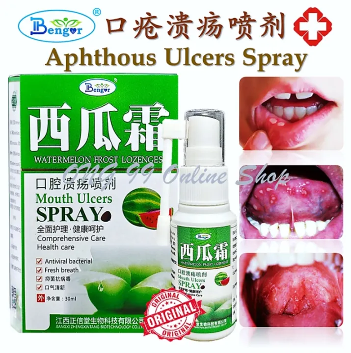 Bengor Ubat Semburan Ulser Mulut HFMD Natural Herbal Mouth Ulcer Oral ...