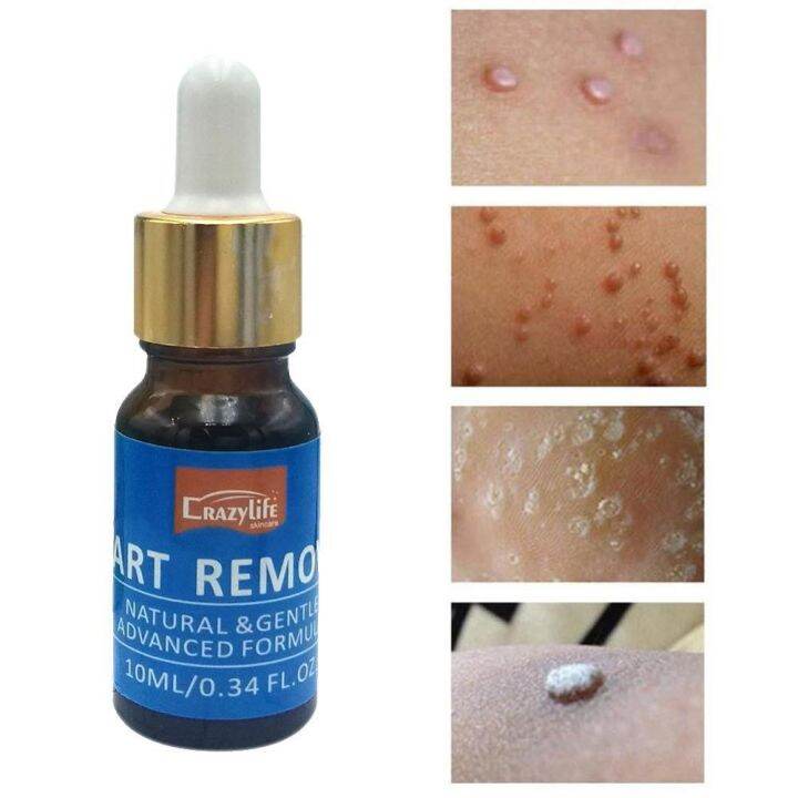 10ML Wart Treatment Papillomas Removal of Warts From Tags Removing ...