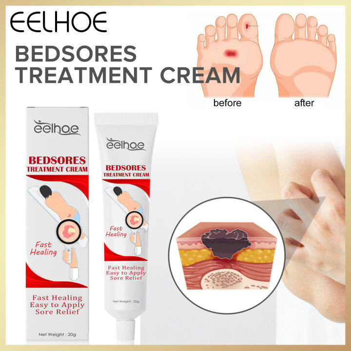 Eelhoe Bedsores Wound Healing Cream Inhibit Fungal Pressure Sores ...