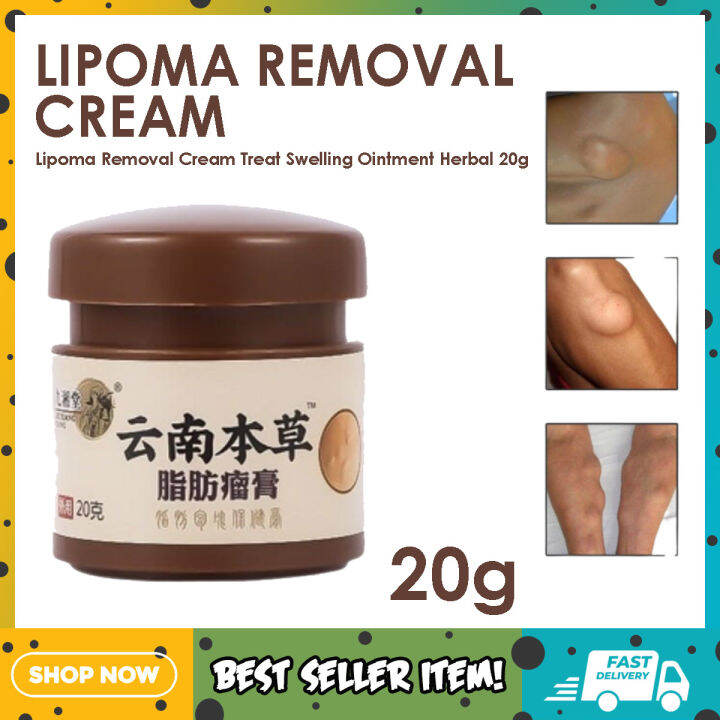 Glorious Lipoma Removal Cream Treat Swelling Ointment Herbal 20g ...