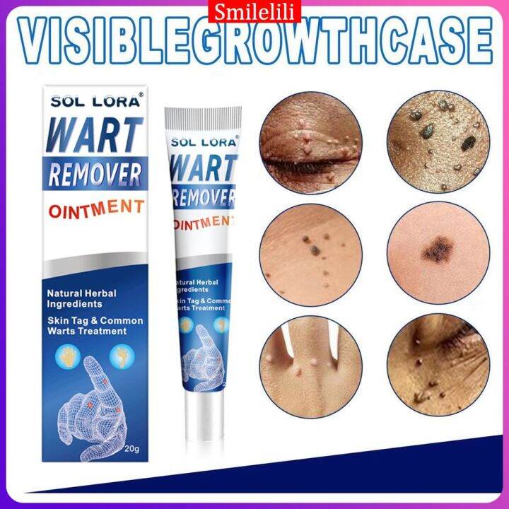 [Smilelili] SOL LORA Wart Removal Cream Filiform Wart Corn Body Flat ...